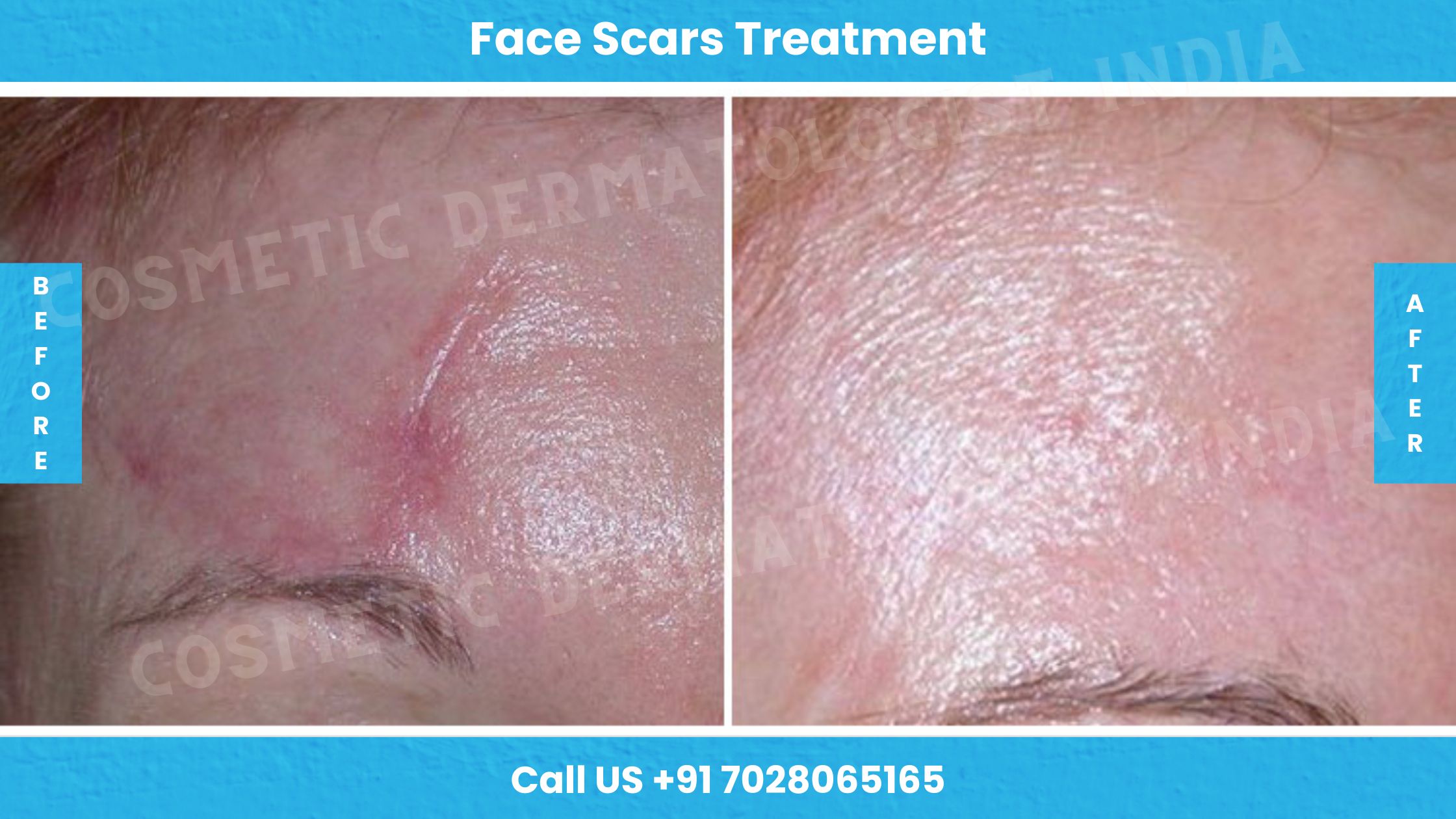 Face Scars Treatment Mumbai Acne Scars Treatment Cost In India Face Scars Treatment Mumbai Acne Scars Treatment Cost In India