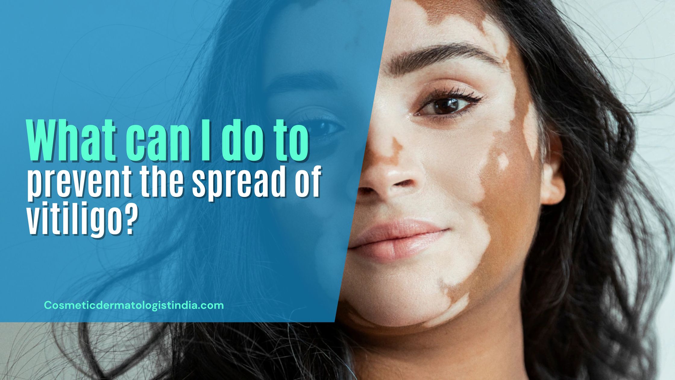 What can I do to prevent the spread of vitiligo? - Cosmetic ...